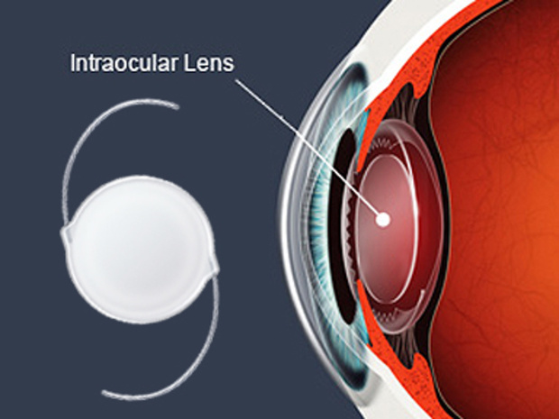Global Intraocular Lens (IOLs) Market Analysis Report 2017-2022